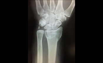 AAOS Clinical Practice Guideline for the Mangement of Distal Radius ...